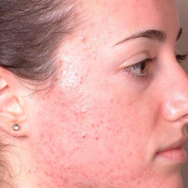 Soins Du Visage | Clinique Médico-Esthétique Thetford